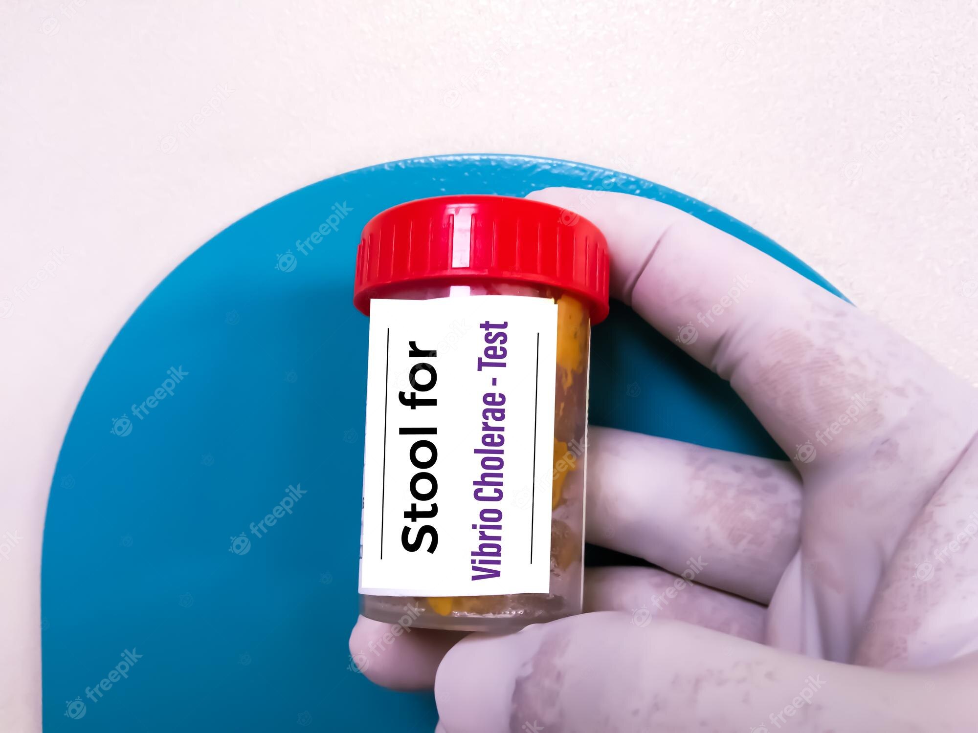 Cholera - Diagnosis And Treatment - bigman lab